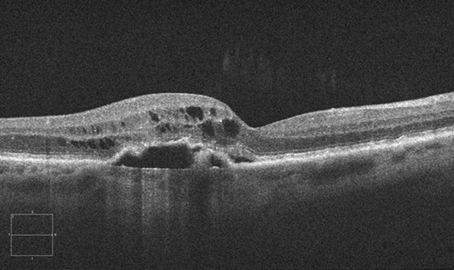 ‘wet’ macular degeneration - Applecross Eye Clinic