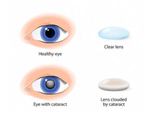 Cataract - Applecross Eye Clinic