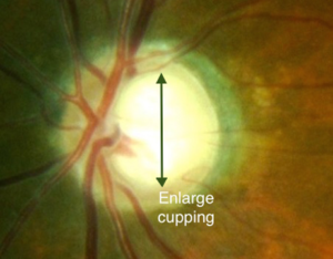 Glaucoma - Applecross Eye Clinic