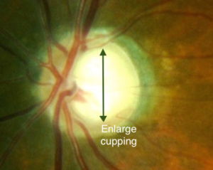 Enlarge cupping - Applecross Eye Clinic