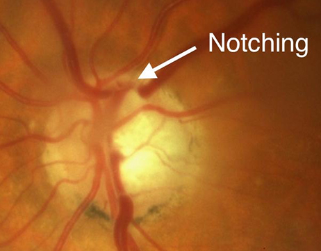 Notching - Applecross Eye Clinic