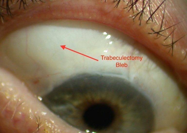 Trabeculectomy Bleb-min - Applecross Eye Clinic