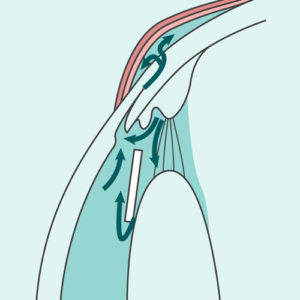 Trabeculectomy - Applecross Eye Clinic