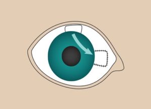 Pterygium Surgery - Applecross Eye Clinic