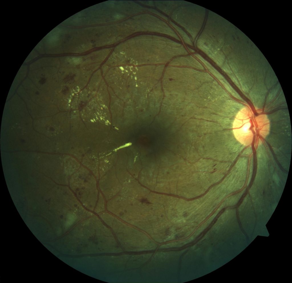 Diabetic Retinopathy - Applecross Eye Clinic
