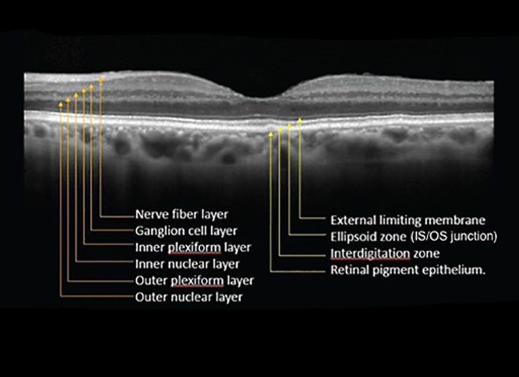 Age Related Macular Degeneration (AMD) - Applecross Eye Clinic