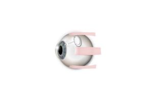 Tube Surgery - Applecross Eye Clinic